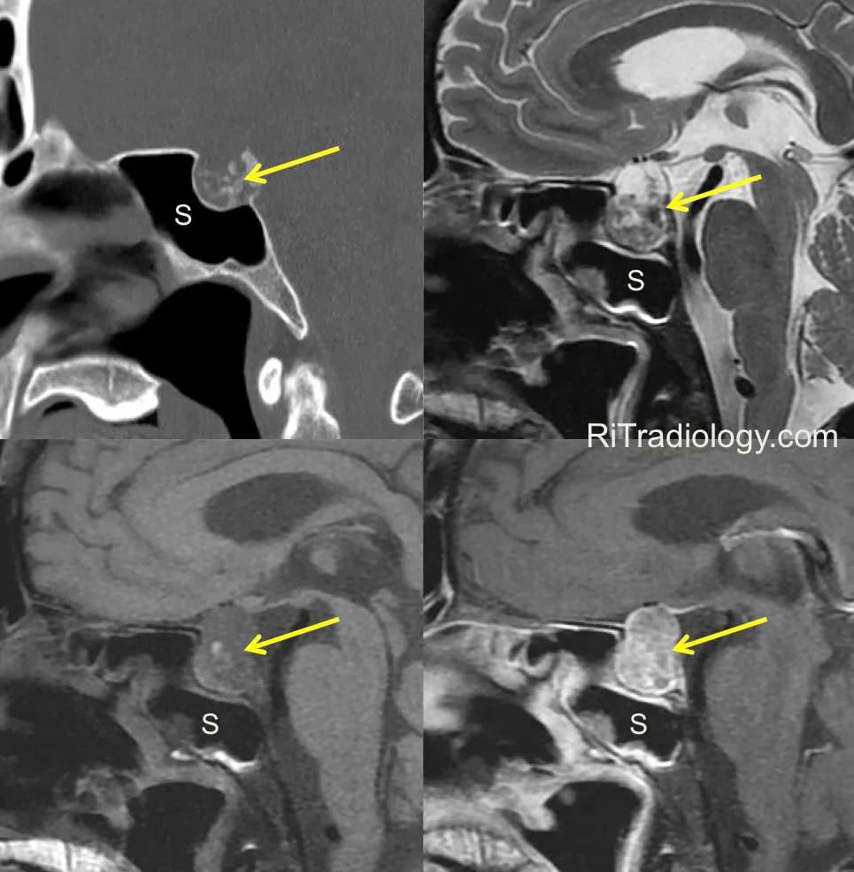 RiT radiology: Sellar Mass with Calcification