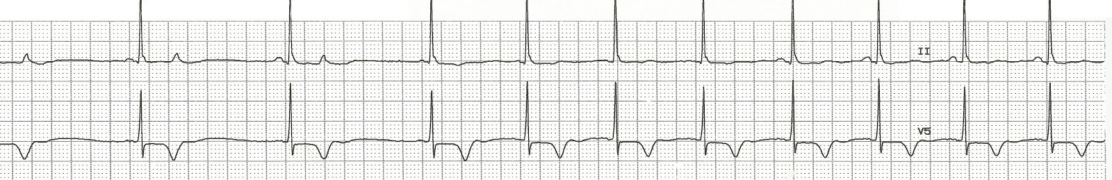 ECG Rhythm Strip Quiz 63