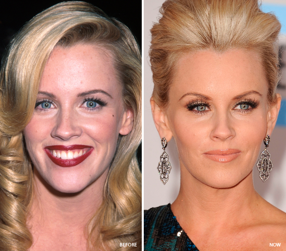 Jenny McCarthy Cosmetic Surgery