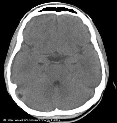 Neuroradiology Cases: Giant Arachnoid granulation