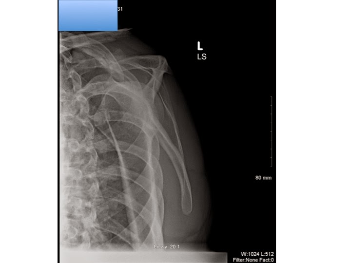 Shoulder and Elbow Surgery: Distal clavicle fracture fixation using ...