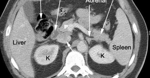 Warungbocah7: Persiapan pasien CT Scan Abdomen Kontras dengan kontras Oral