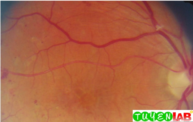 [Emergency] Atlas of Hypertensive retinopathy | Free Medical Atlas