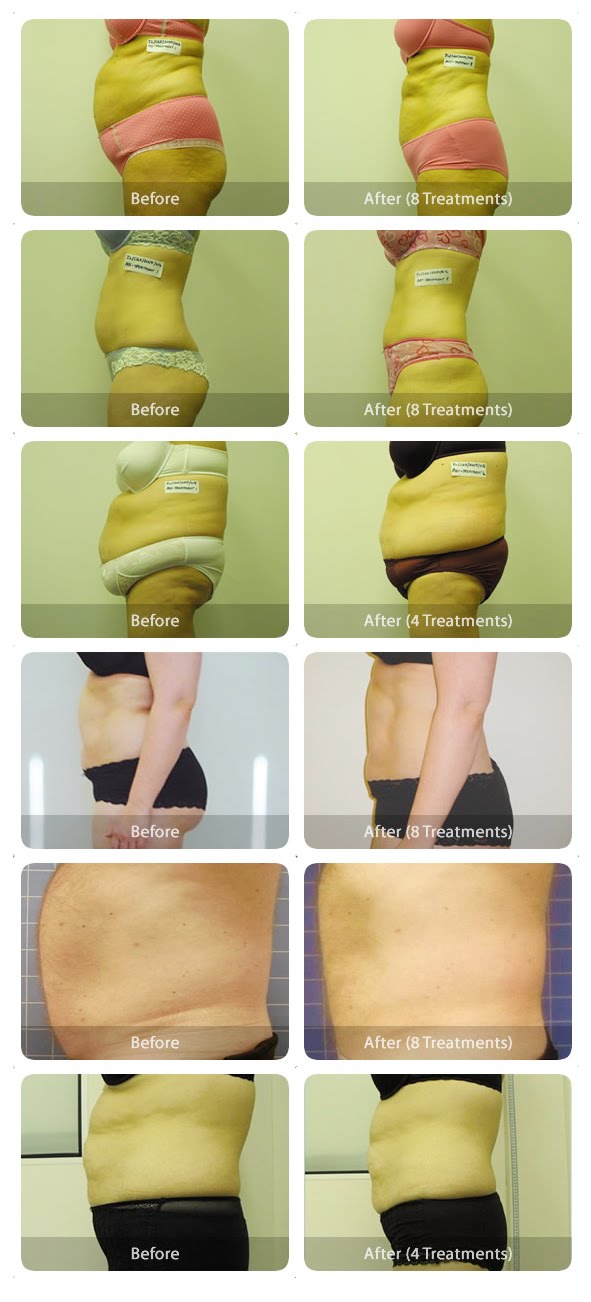 Love Hair Love Beauty Blog: i-Lipo - The intelligent alternative to ...
