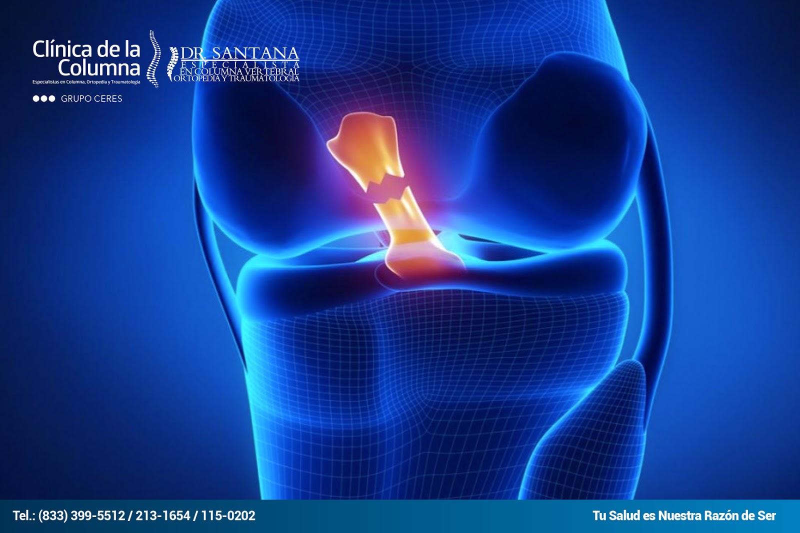 (LCA) Lesión del ligamento cruzado anterior - Clínica de la Columna ...