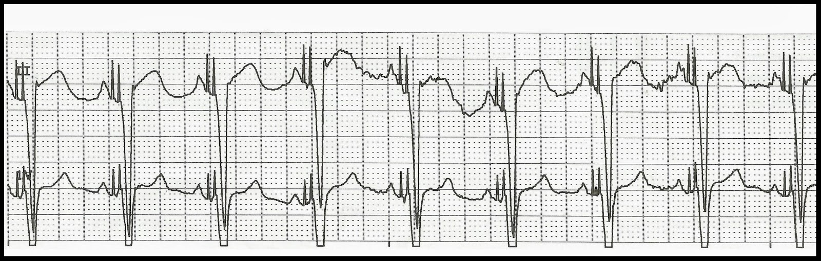 EKG Rhythm Quiz 246