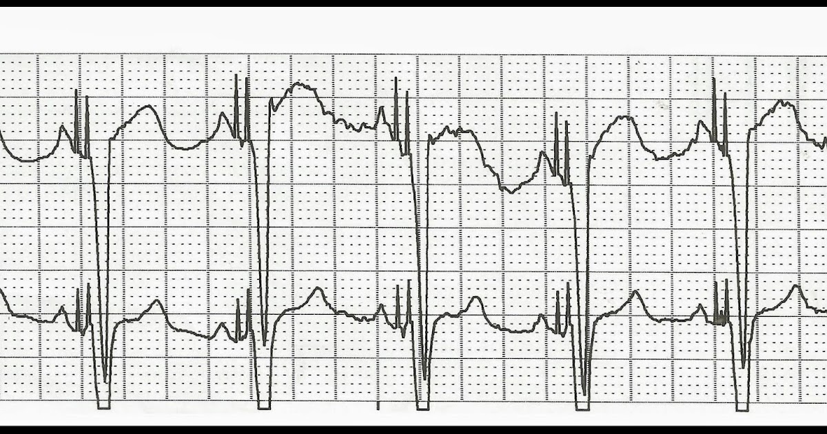 Float Nurse: Various Biventricular Paced Rhythms