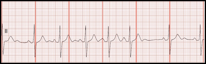 Practice EKG Rhythm Strips 138