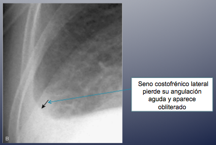 IDENTIFICACIÓN DE UN DERRAME PLEURAL: Ángulo costofrénico lateral ...