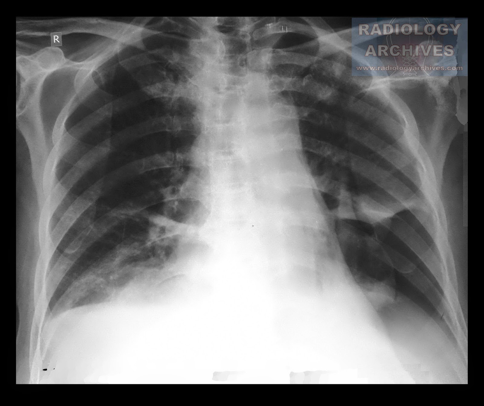 Radiology Archives: Πνευμοθώρακας (Deep Sulcus Sign)
