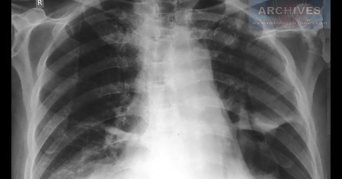 Radiology Archives: Πνευμοθώρακας (Deep Sulcus Sign)