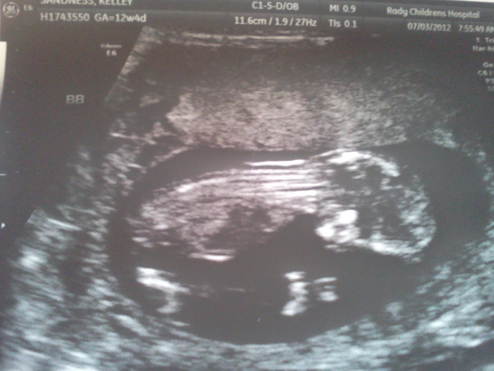 Team Sandness: 12 Week Ultrasound Nuchal Translucency (NT) Scan