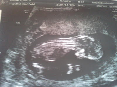 Team Sandness: 12 Week Ultrasound Nuchal Translucency (NT) Scan