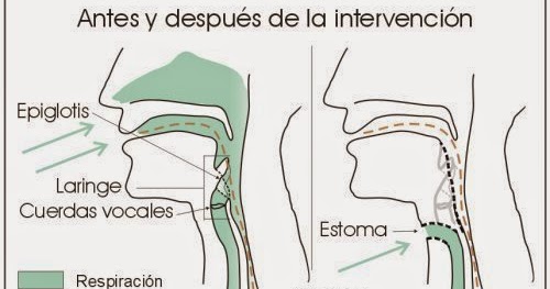 Asociación Barcelonesa de Laringectomizados: Cuidados tras una ...