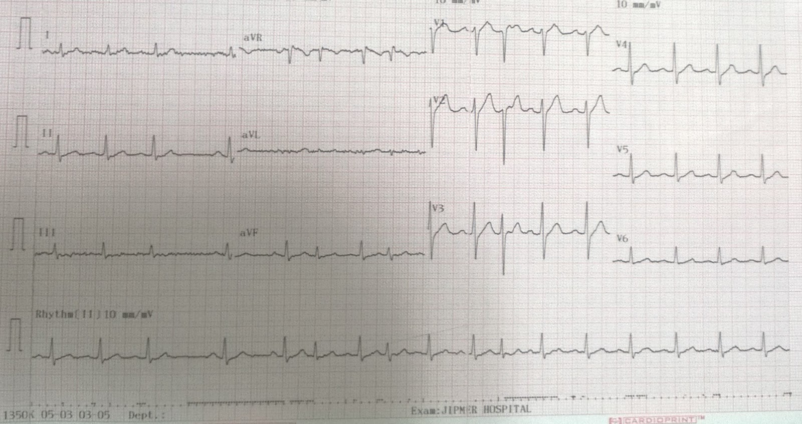Cardiology window: Atrial tachycardia