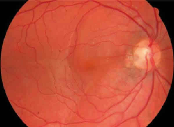 ¿Qué es la Foseta del Nervio Óptico? - Por Una Visión Saludable