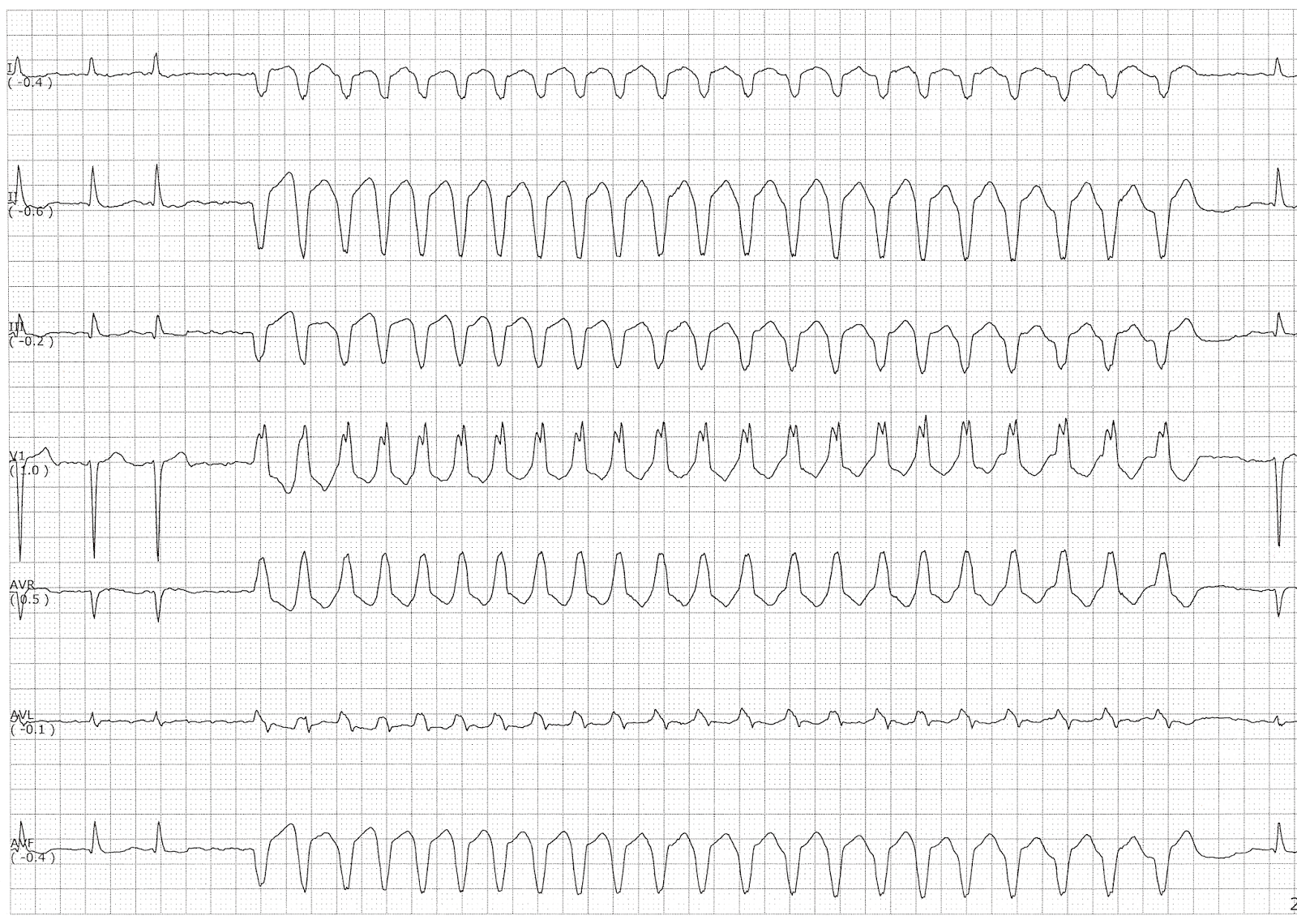 Float Nurse: Atrial fibrillation with a Run of Ventricular Tachycardia