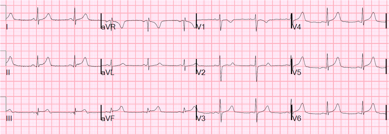Dr. Smith's ECG Blog: Atypical Chest Pain: Suspicious ECG, and a Left ...