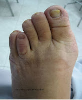 Foot Deformities in CT: My Fourth Toe Is Very Short!