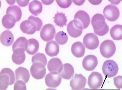 Celulas Sanguineas: Atlas de hematología: Anormalidades serie eritroide.