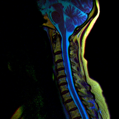 Nevit's blog: Cervical spine Color MRI