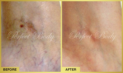 Perfect Body Laser and Aesthetics: Superficial Vein Removal