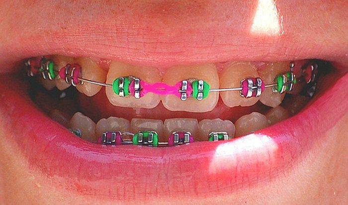 Ortodoncia : Ligas en los Brackets