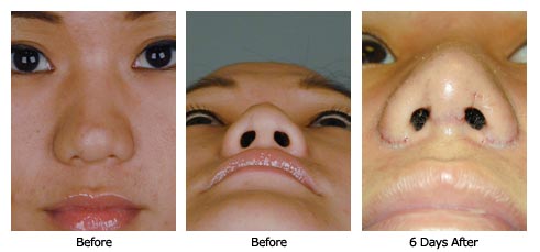 Alar Base Reduction - Reduce nose wings