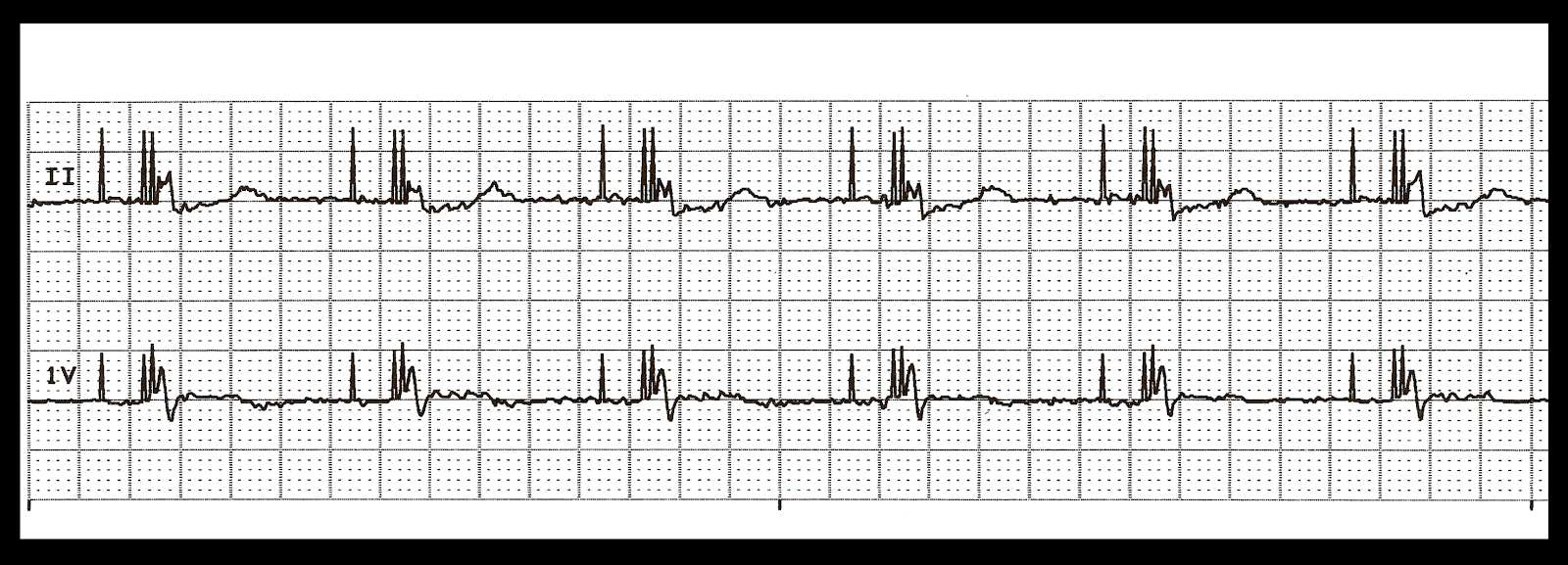Practice EKG Strips 374