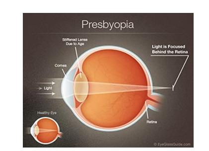 Presbiopia | Kumpulan Tips Kesehatan