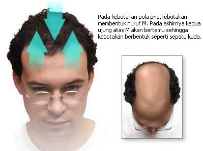 Mitos Rambut Rontok dan Solusi Tepat Mengatasinya - Masalah Pria