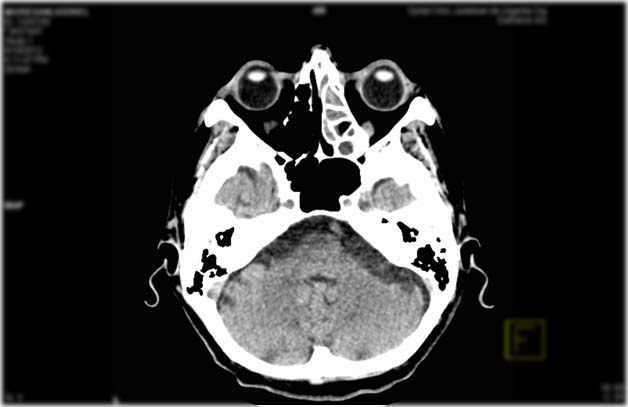 Pansinusitis on the left side - CT Scan