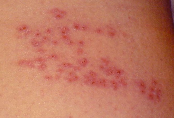 About Health: Shingles