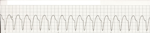 Identify the appropriate electrical intervention for the following EKG ...