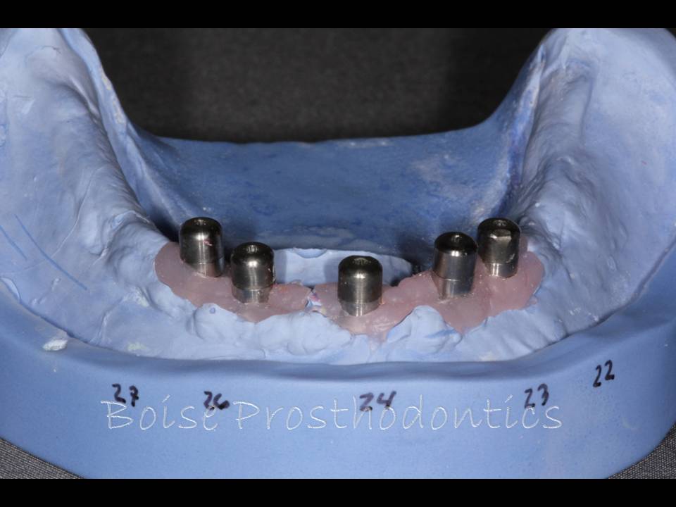 Boise Idaho Prosthodontics: Picture Sequence of Maxillary Complete ...