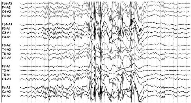 pediatric neurology: Epileptiform K-complexes and sleep spindles