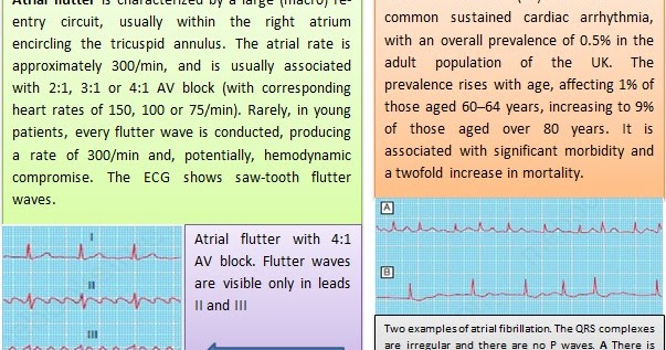 What are the causes of Atrial Flutter/Fibrillation?
