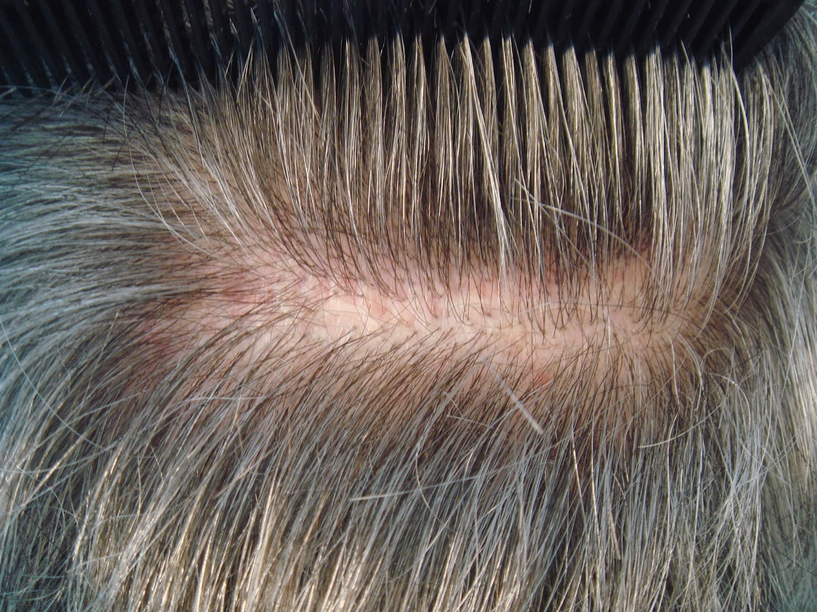 hair transplant: FUT Scars