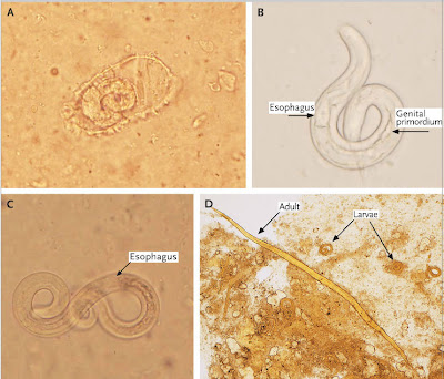 Medical Laboratory and Biomedical Science: Strongyloides stercoralis ...