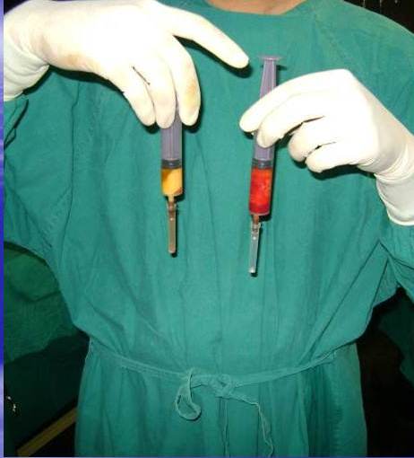 Plastic and Cosmetic Surgery: Fat Injection – A boon for the Plastic ...