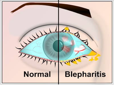 Mellis Eyecare: Blepharitis