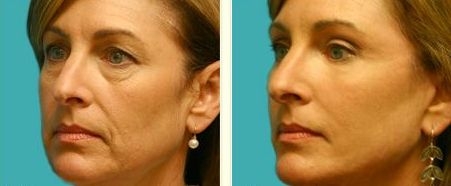 Chubby Cheeks Exercises To Improve The Middle And Lower Face