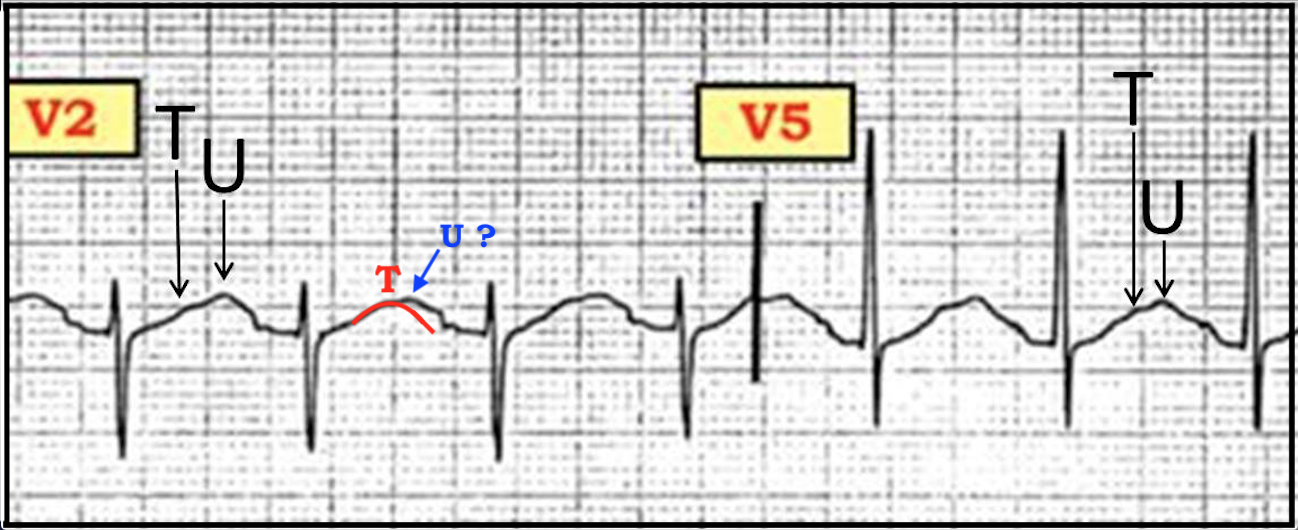 ECG Interpretation