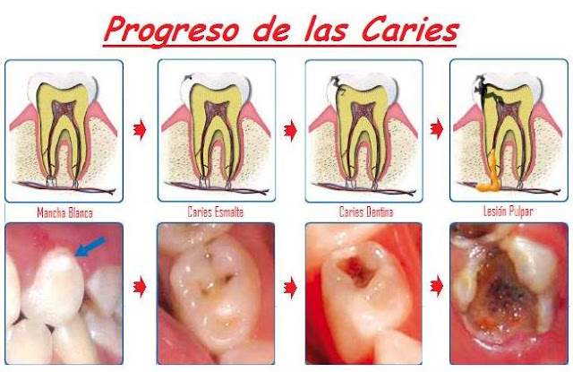 ¿Qué son las caries dentales y cómo se producen?