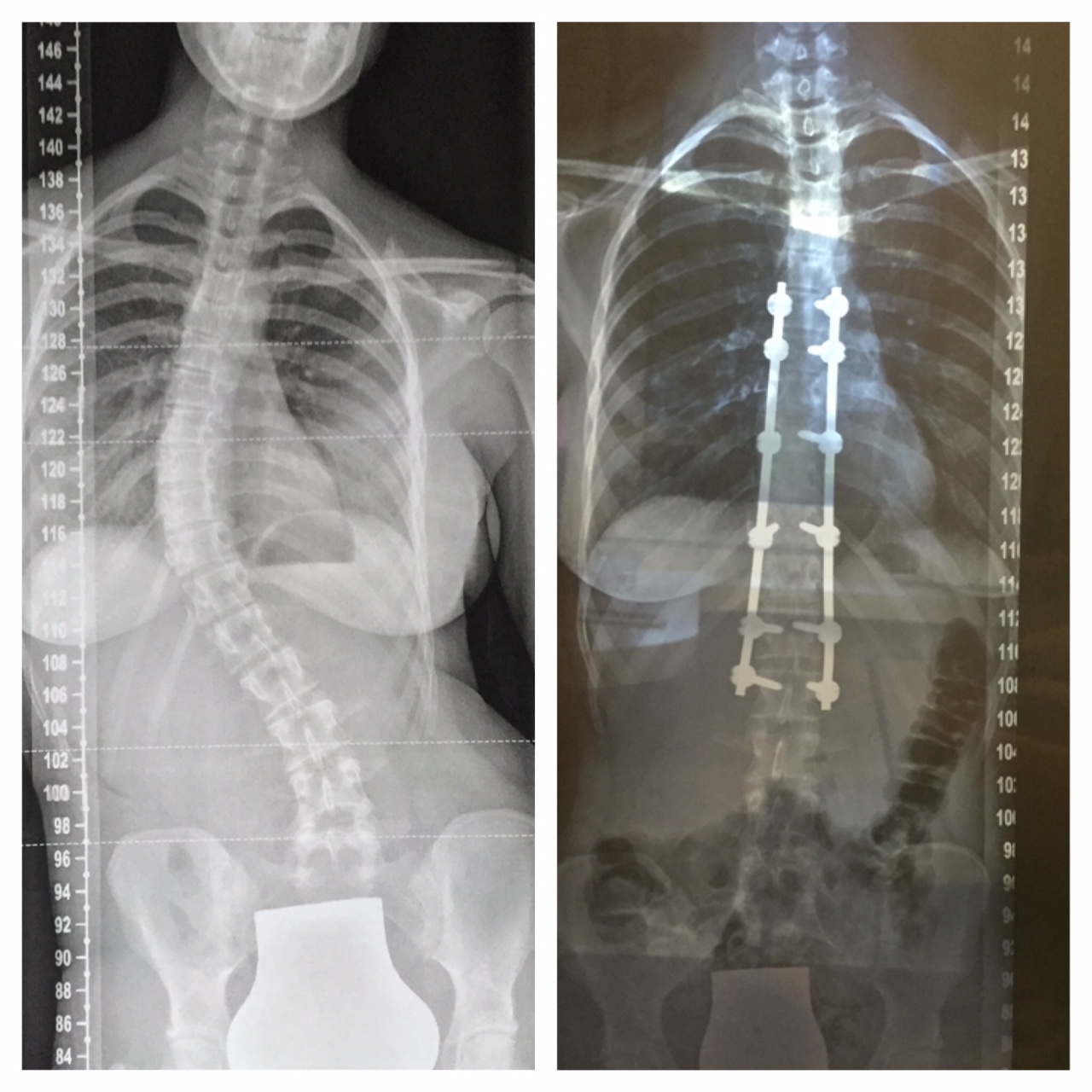 scolima: Meine Skoliose