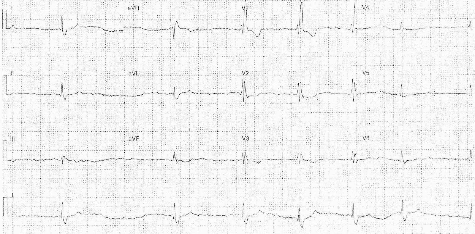ECG of the Week: ECG of the Week - 1st October 2018