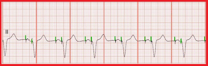 EKG Rhythm Strip Quiz 154
