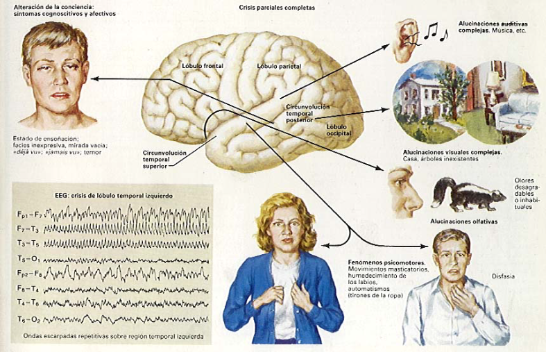 Blog Dr. Carlos: Crise parcial complexa (Epilepsia)