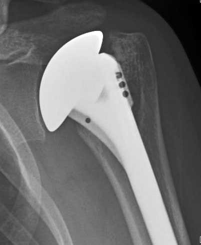 UW Shoulder and Elbow Academy: Hemiarthroplasty for avascular necrosis