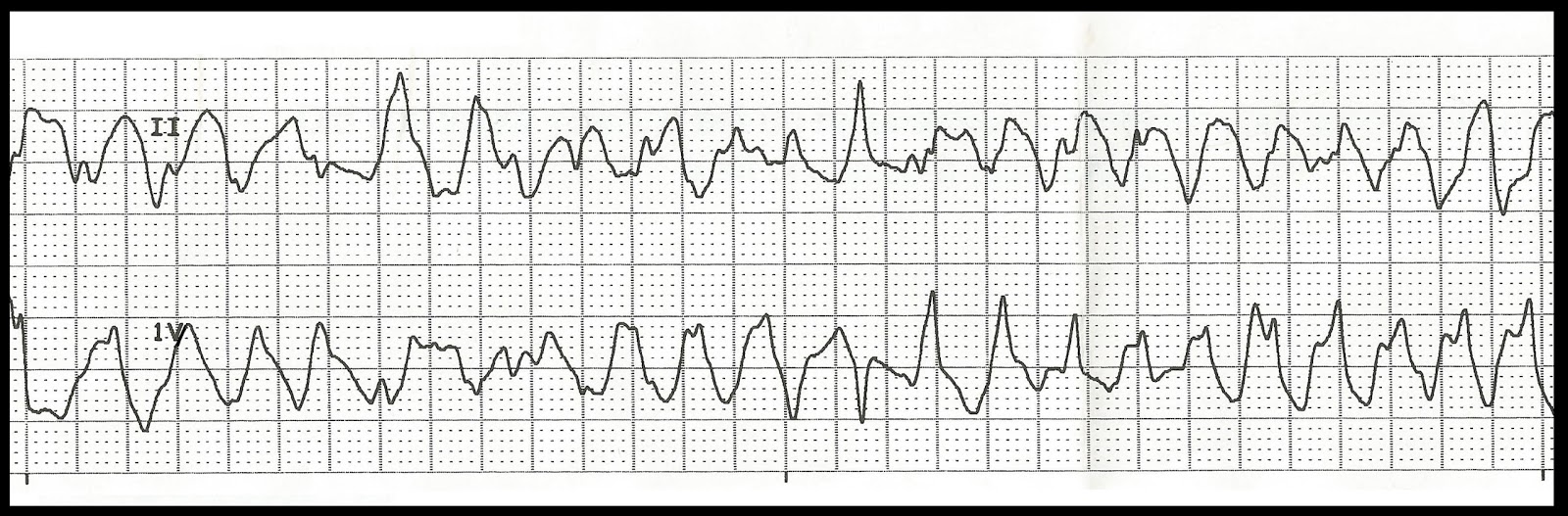 EKG Rhythm Strip Quiz 122